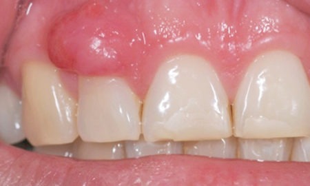 Tengo un bulto en la encía: ¿Qué puede ser y cómo se quita? - Artículos